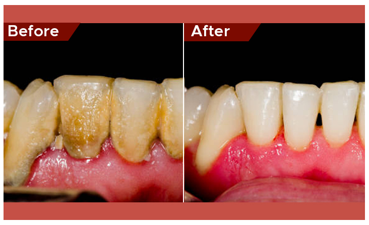Gum Disease Treatment in Abu Dhabi |Gum Specialist in Abudhabi UAE